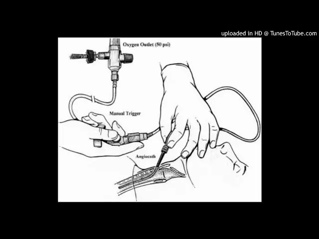 Ventilación A Chorro Transtraqueal | La Casa Del Ventilador